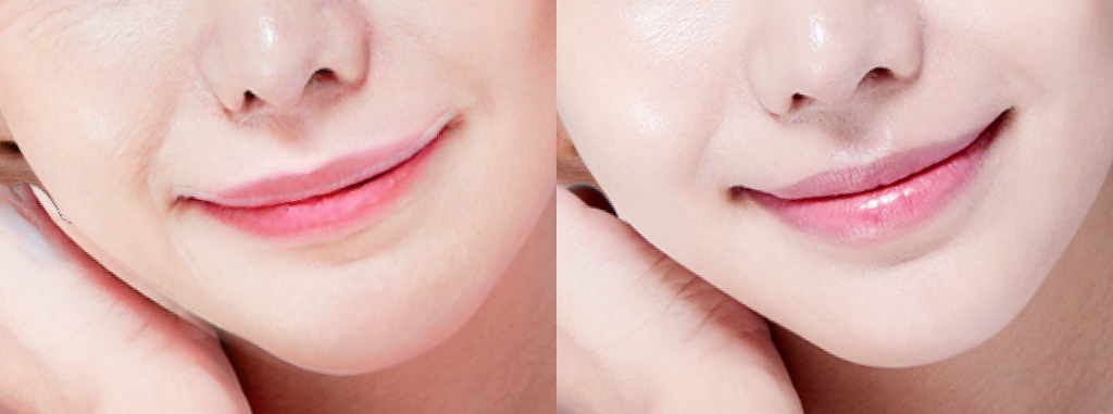 Titanium Lifting Laser: Achieve a Sculpted V-Line Face!