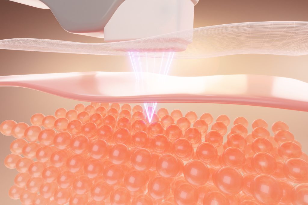 Best Treatment for Enlarged Pores? The Popular Secret Laser - Yeoti WIKI