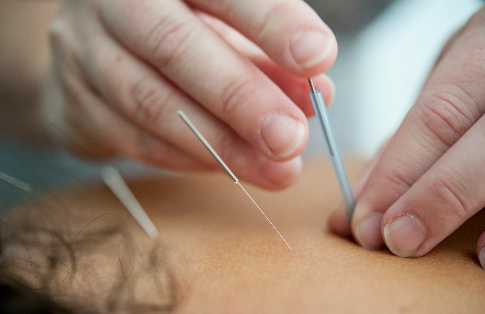 Acupuncture Injection Therapy: A Holistic Fusion of Eastern
